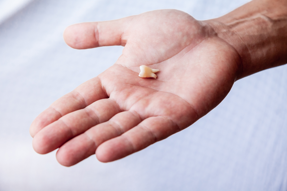 Steps To Take When You Knock Out a Tooth | McComb Family Dental